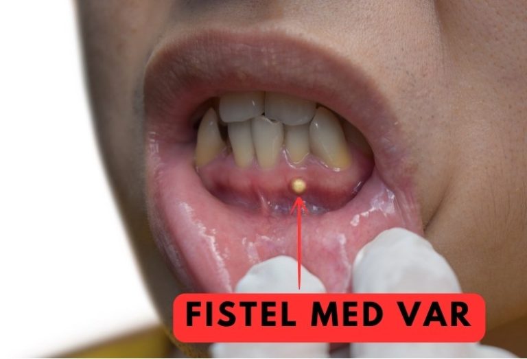 Fistel i munnen: Orsak & behandling » TandUpplysningen